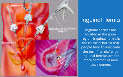 Inguinal Hernia – Colorectal Cancer Surgery
